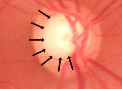 Haut 76 Images Fond D Oeil Normal Fr Thptnganamst Edu Vn