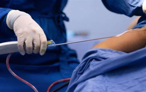 Is Coolsculpting Mons Pubis Perfect For Lovely Pubic Area Check The