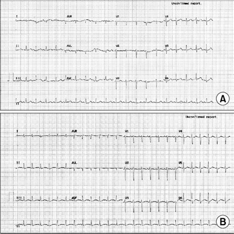 Electrocardiogram A At The Recovery Room Showing Sinus Tachycardia