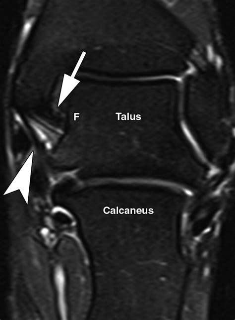 MRI And Surgical Findings In Deltoid Ligament Tears AJR