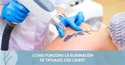 Cómo funciona la eliminación de tatuajes con láser Medicina Estética