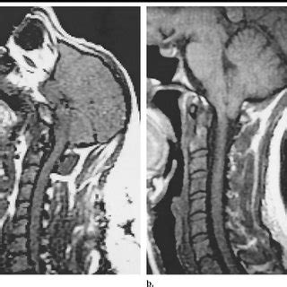 Sagittal Two Dimensional Spin Echo T1 Weighted MR Images 450 14 Of