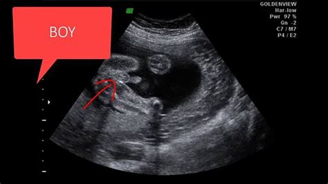 900 hình ảnh siêu âm 4D bé trai 12 tuần sắc nét và rõ ràng nhất Chia