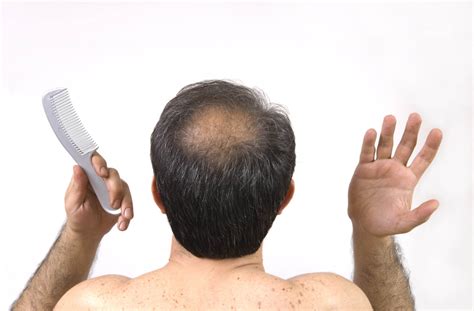 Perte De Cheveux Chez L Homme Pourquoi Et Que Faire