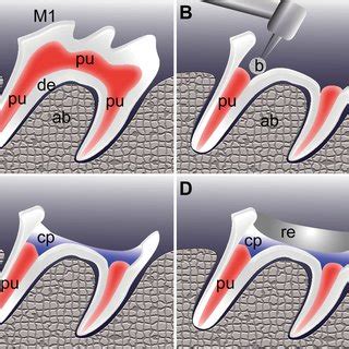 Pulpotomy
