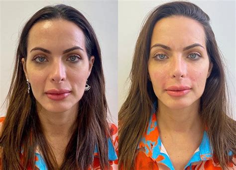 Introducir 77 Imagen Modelo Botox Abzlocal Mx