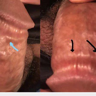 Firm Cord Like Swelling With Beaded Texture On The Dorsum Of The Distal