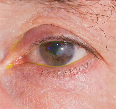 Mild Ocular Herpes