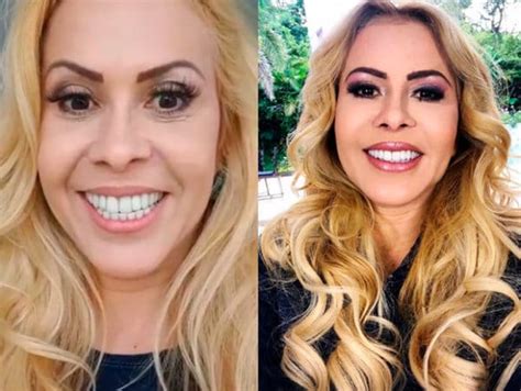 Md Codes Famosas Que Fizeram Harmoniza O Facial Cl Nica Coderm