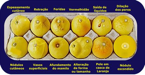 Prof Dr Gil Facina Sintomas E Sinais Do C Ncer De Mama