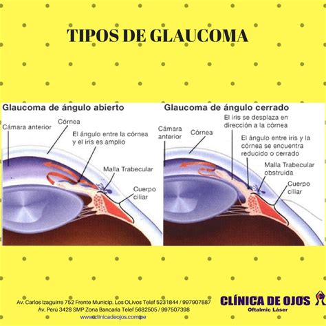 Clínica de Ojos Oftalmic Láser TIPOS DE GLAUCOMA