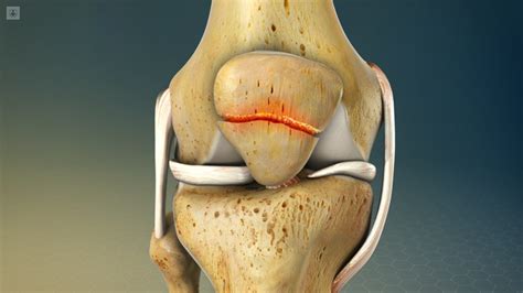 Fractura de Rodilla qué es síntomas y tratamiento Top Doctors