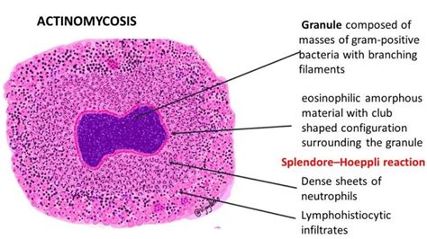 Actinomycosis