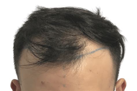 resultados transplante capilar españa Capyderma Transplante Capilar