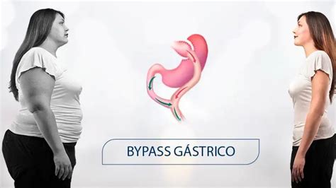 Qué es el Bypass Gástrico Cirugía Bariátrica en Bogotá