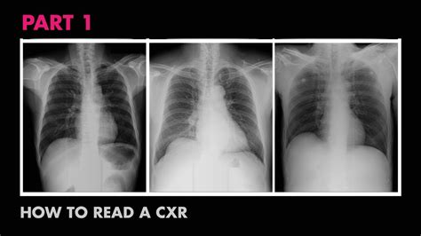 Anatomy Of A Chest X Ray How To Read A Chest X Ray Part Youtube