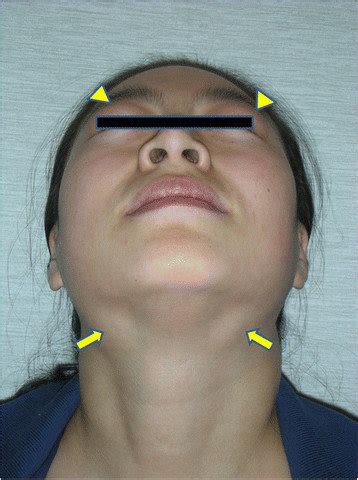 Enlargement Of The Lacrimal Arrowheads And Submandibular Glands