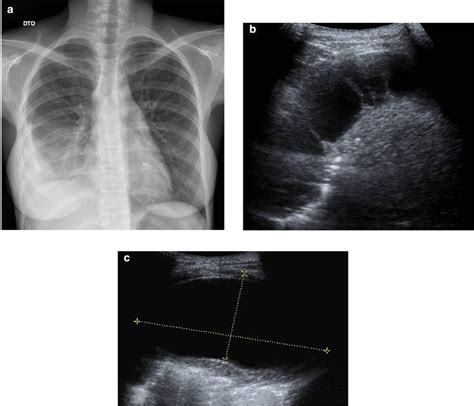A Chest Radiograph Shows A Right Loculated Pleural Effusion B C