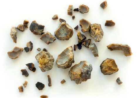 Pedra nos rins Cálculo Renal Sintomas Causas e Tratamentos Saúde
