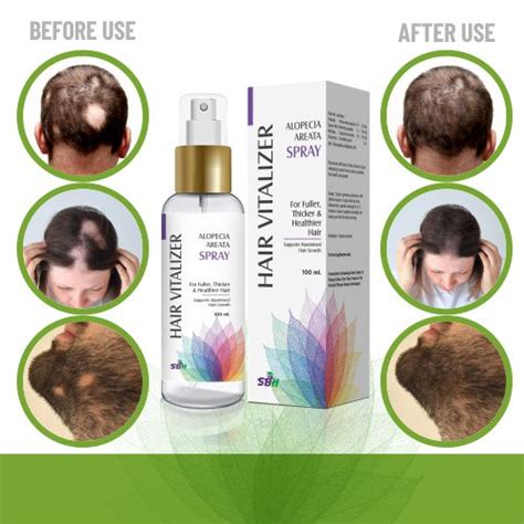 Alopecia Areata Spray Best Ayurvedic Treatment Medicine