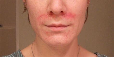 Dermatite perioral é contagiosa Conheça o tratamento remédios