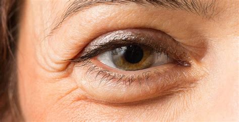 Olhos Inchados 8 Principais Causas E O Que Fazer Para Tratar Descubra
