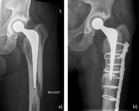 A Type B Periprosthetic Femoral Fracture Around Cemented Polished
