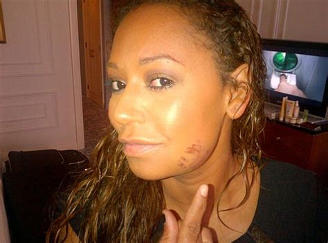 What Did Spice Girl Mel B Do To Her Face