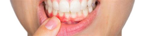 Gingivita Cauze Simptome Tratament Si Prevenire Prestige Dent