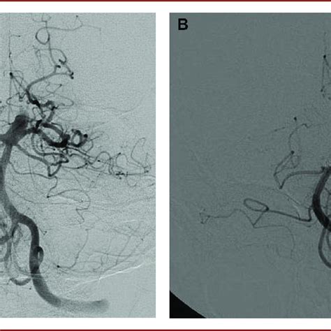 A Digital Subtraction Angiography DSA Shows A Basilar Tip Saccular