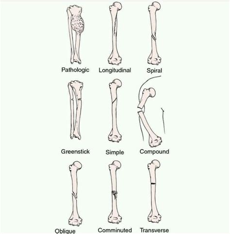 Type Of Bone Fracture Medizzy