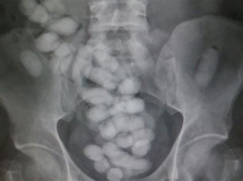 Fiumicino Atterra Con 100 Ovuli Di Eroina In Corpo Il Nuovo Magazine