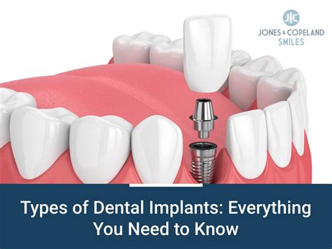 Comparing The Different Types Of Dental Implants