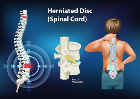 Herniated Disc Diagram