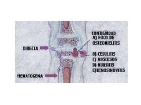 Artritis Septica PPT Descarga Gratuita