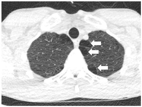Pneumothorax Radiographie Pulmonaire