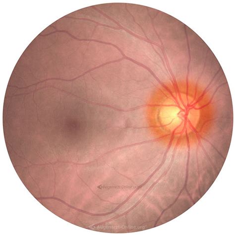 Beurteilung Papille Fundus Trainer