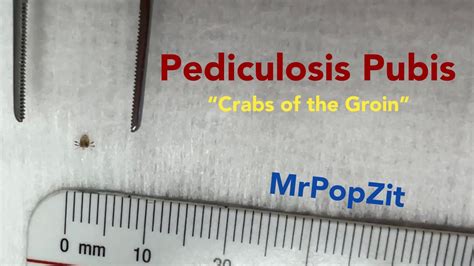 Pediculosis Pubis Crabs Can Cause Severe Itching And Discomfort