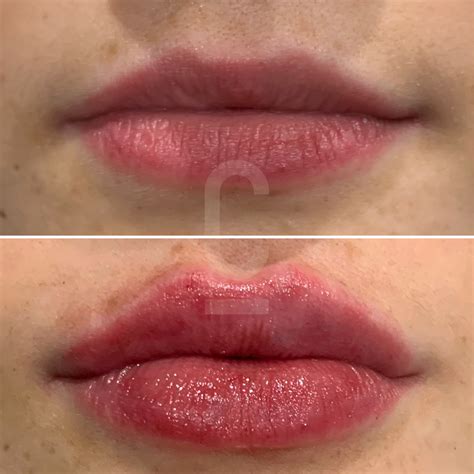 Understanding Lip Filler Results Cosmetic Connection