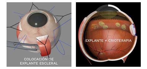 Desprendimiento de retina Oftalmología Avanzada
