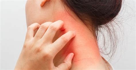 Macchie Rosse Sul Viso Rimedi Naturali Prodotto Speciale Pulizia Viso