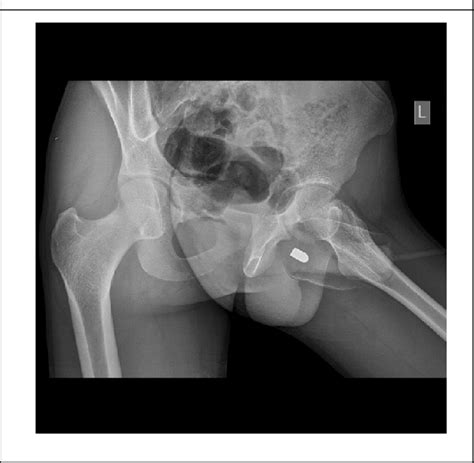 Pelvis Lateral View X Ray