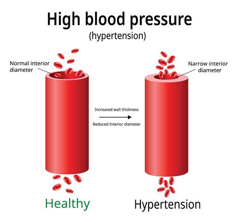 What Is Blood Pressure What Are The Types And Things To Consider Bulb