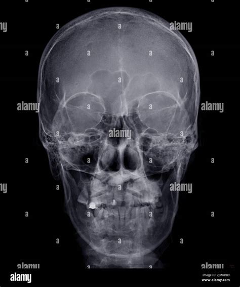 Skull X Ray Image Of Human Name Is Skull AP View Isolated On Black
