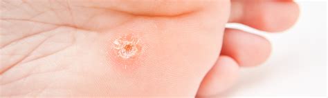Warts Treatment McLean Potomac Dermatology