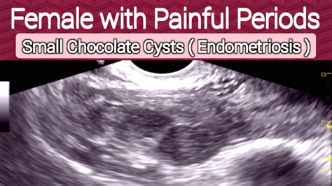 Small Ovarian Chocolate Cysts Endometriosis Infertility
