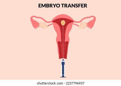 Embryo Transfer Embryon Uterus Embryo Transfer Stock Vector Royalty