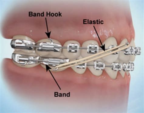 What Are Elastics Rubberbands And How Do They Help With My Braces