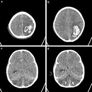 Tomografía axial computarizada cerebral Download Scientific Diagram