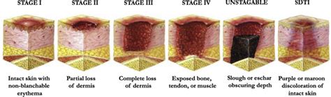 How To Keep Patients Un HAPI Cardiac Surgery And Sacral Pressure